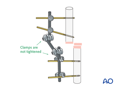 Modular external fixation