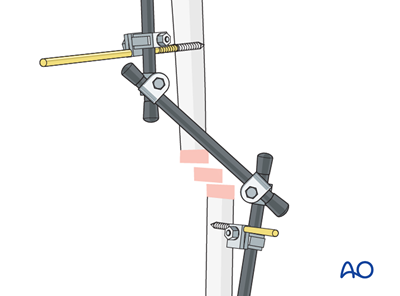 Modular external fixation