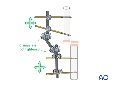 Modular external fixation