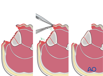 Principles of management of open fractures
