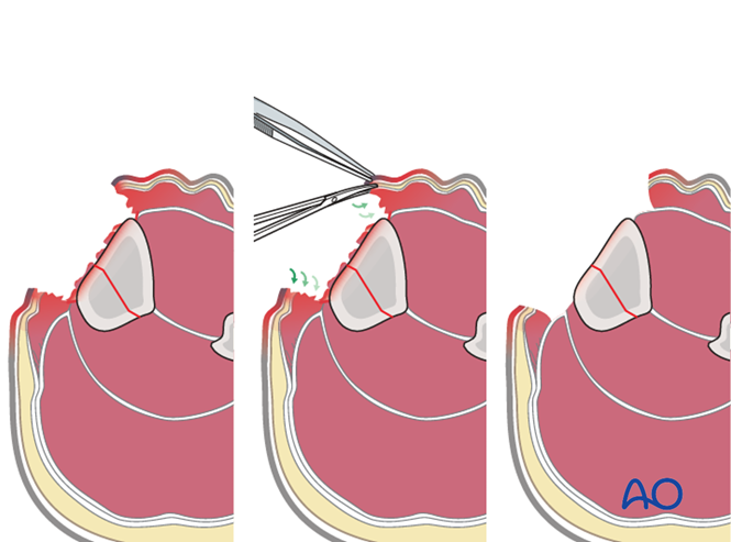Principles of management of open fractures