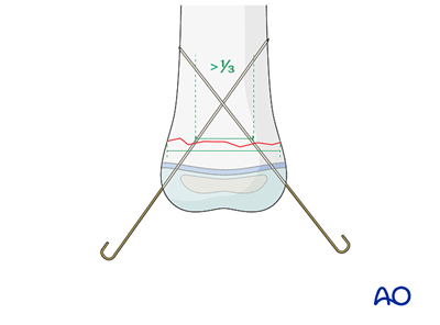 General K-wire principles