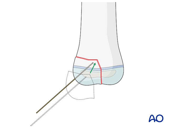 General K-wire principles