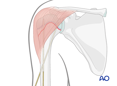 General K-wire principles