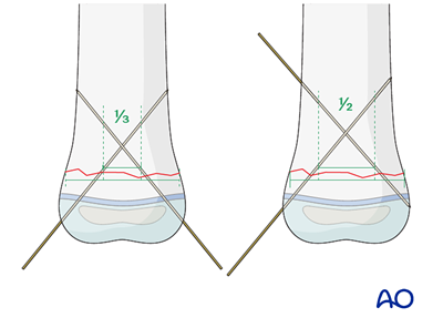 General K-wire principles