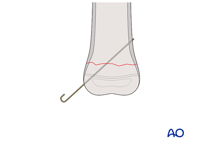 General K-wire principles