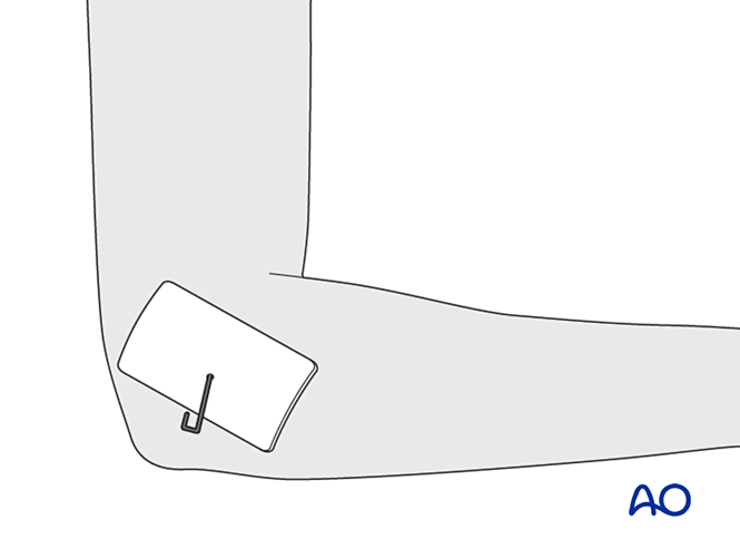 General K-wire principles