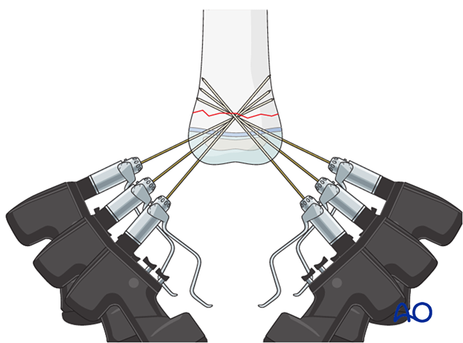 General K-wire principles