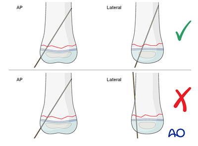 General K-wire principles