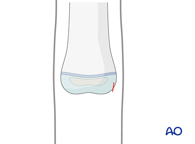 General K-wire principles