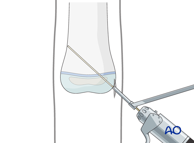 General K-wire principles