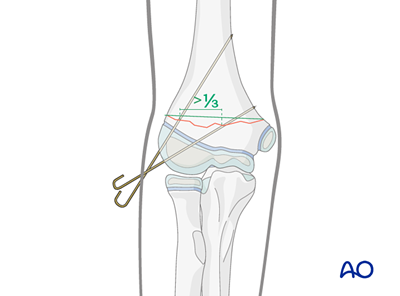 General K-wire principles