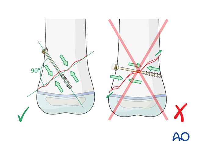 Lag-screw principles