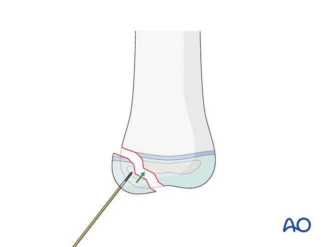 Lag-screw principles