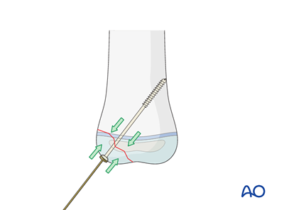 Lag-screw principles