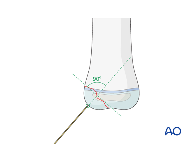 Lag-screw principles