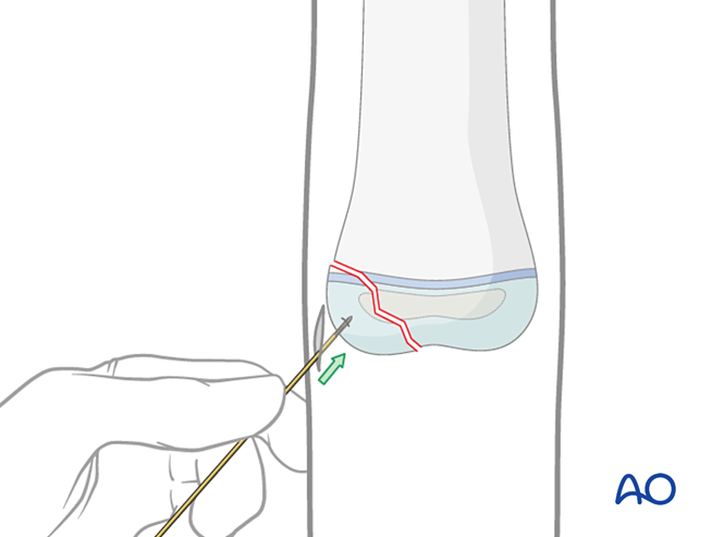 Lag-screw principles