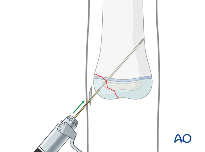 Lag-screw principles