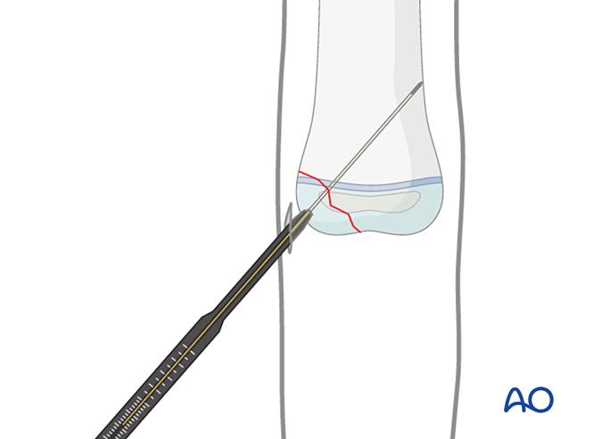 Lag-screw principles