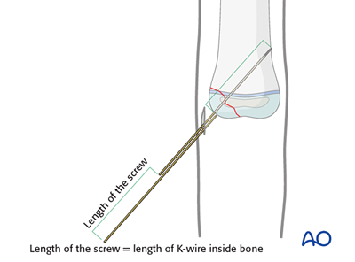 Lag-screw principles