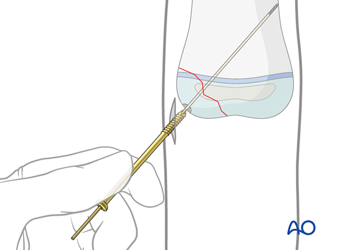 Lag-screw principles