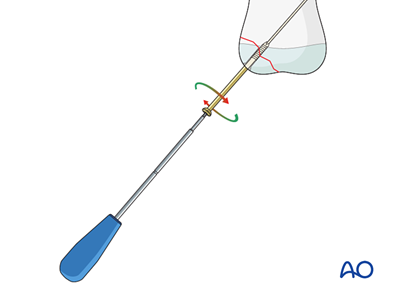 Lag-screw principles