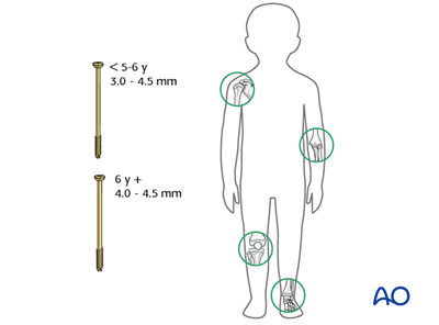 Lag-screw principles