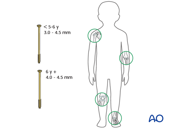 Lag-screw principles