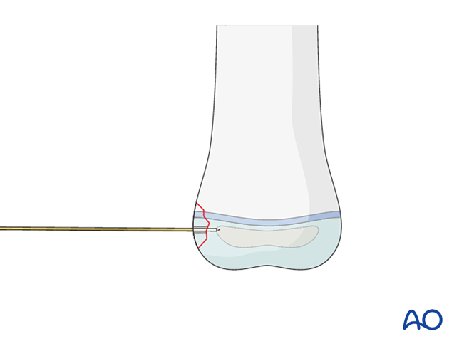 Lag-screw principles