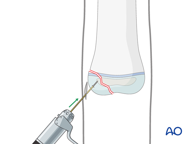 Lag-screw principles