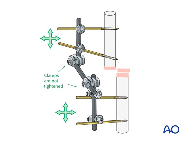Modular external fixation