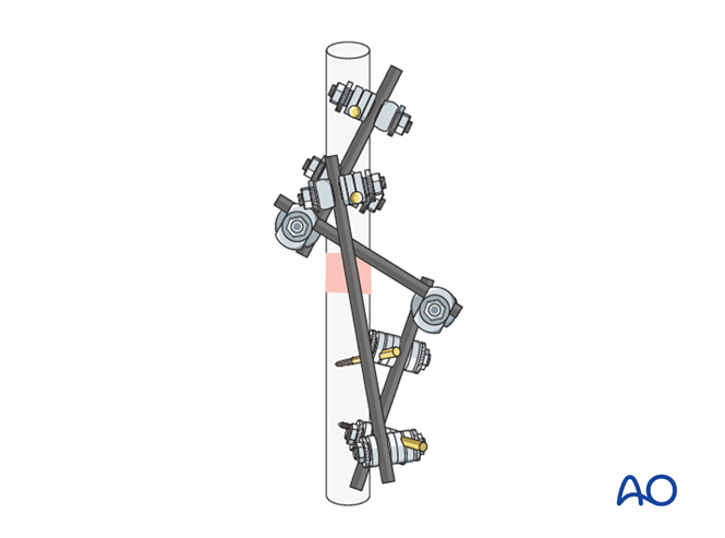 Modular external fixation