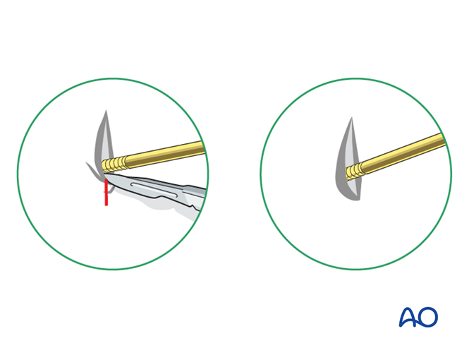 Modular external fixation