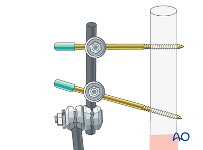 Modular external fixation