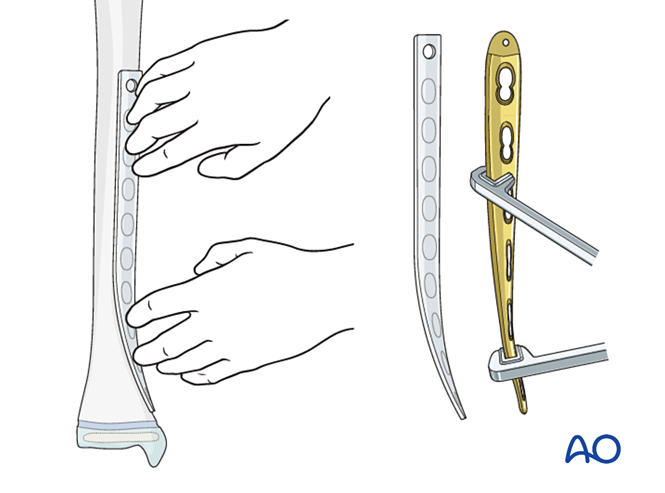 Plating principles in pediatric fracture care