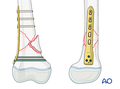 Plating principles in pediatric fracture care