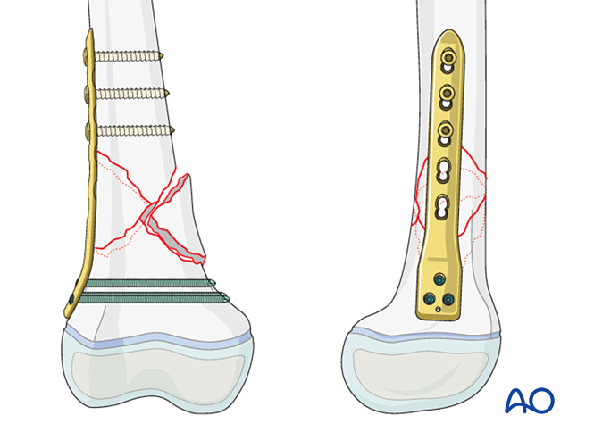 Plating principles in pediatric fracture care