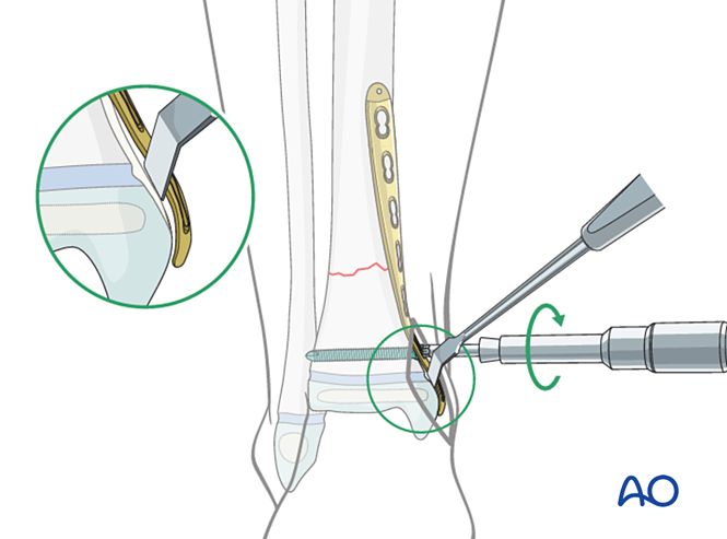 Plating principles in pediatric fracture care