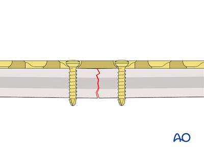 Plating principles in pediatric fracture care