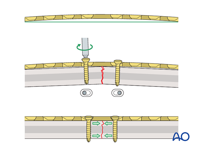 Plating principles in pediatric fracture care