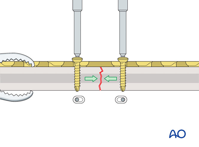 Plating principles in pediatric fracture care