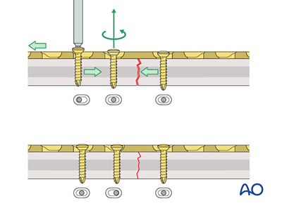 Plating principles in pediatric fracture care