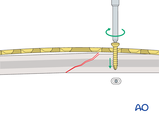 Plating principles in pediatric fracture care