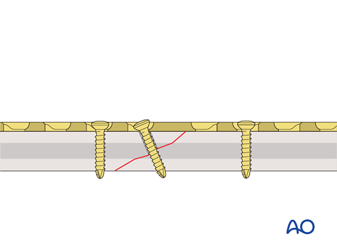 Plating principles in pediatric fracture care