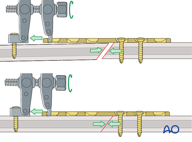 Plating principles in pediatric fracture care