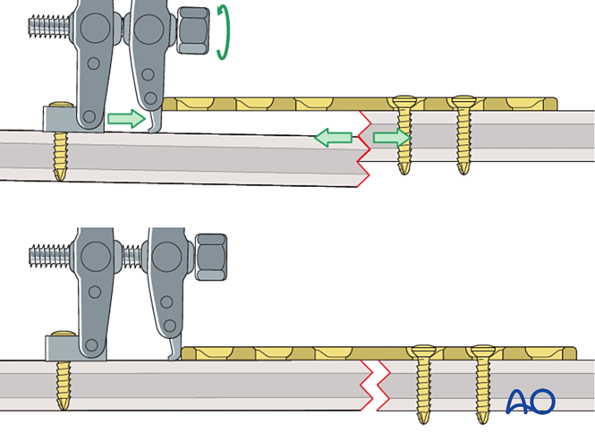 Plating principles in pediatric fracture care