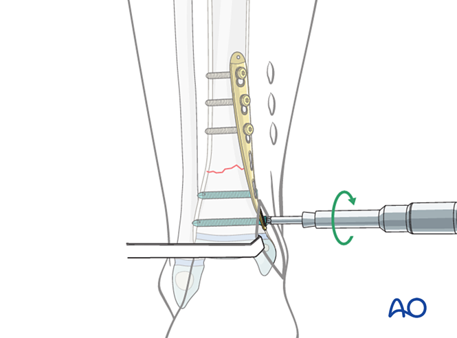 Plating principles in pediatric fracture care