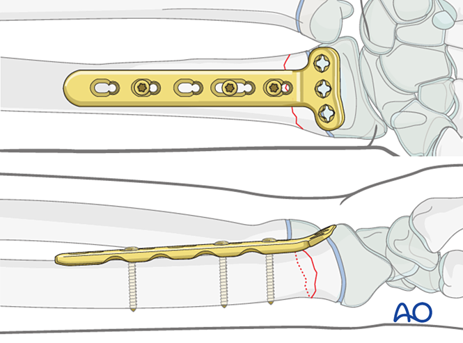 Plating principles in pediatric fracture care