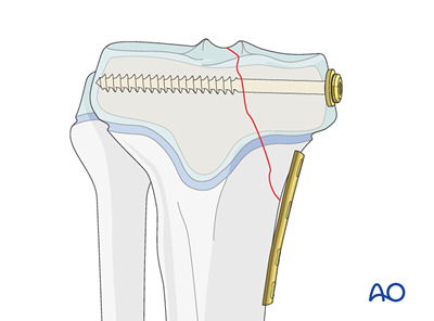 Plating principles in pediatric fracture care