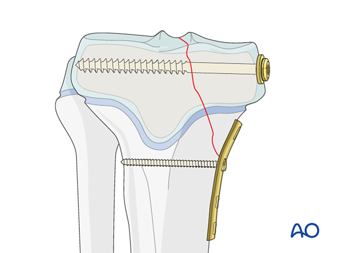Plating principles in pediatric fracture care